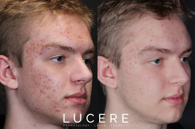 Adult-Onset Acne: What It Is and How It Can Be Treated | Lucere