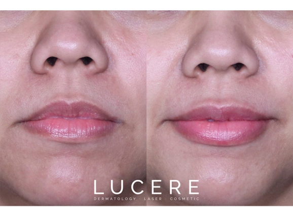 Botox Before & After | Botox & Filler | Botox Results | Lucere ...