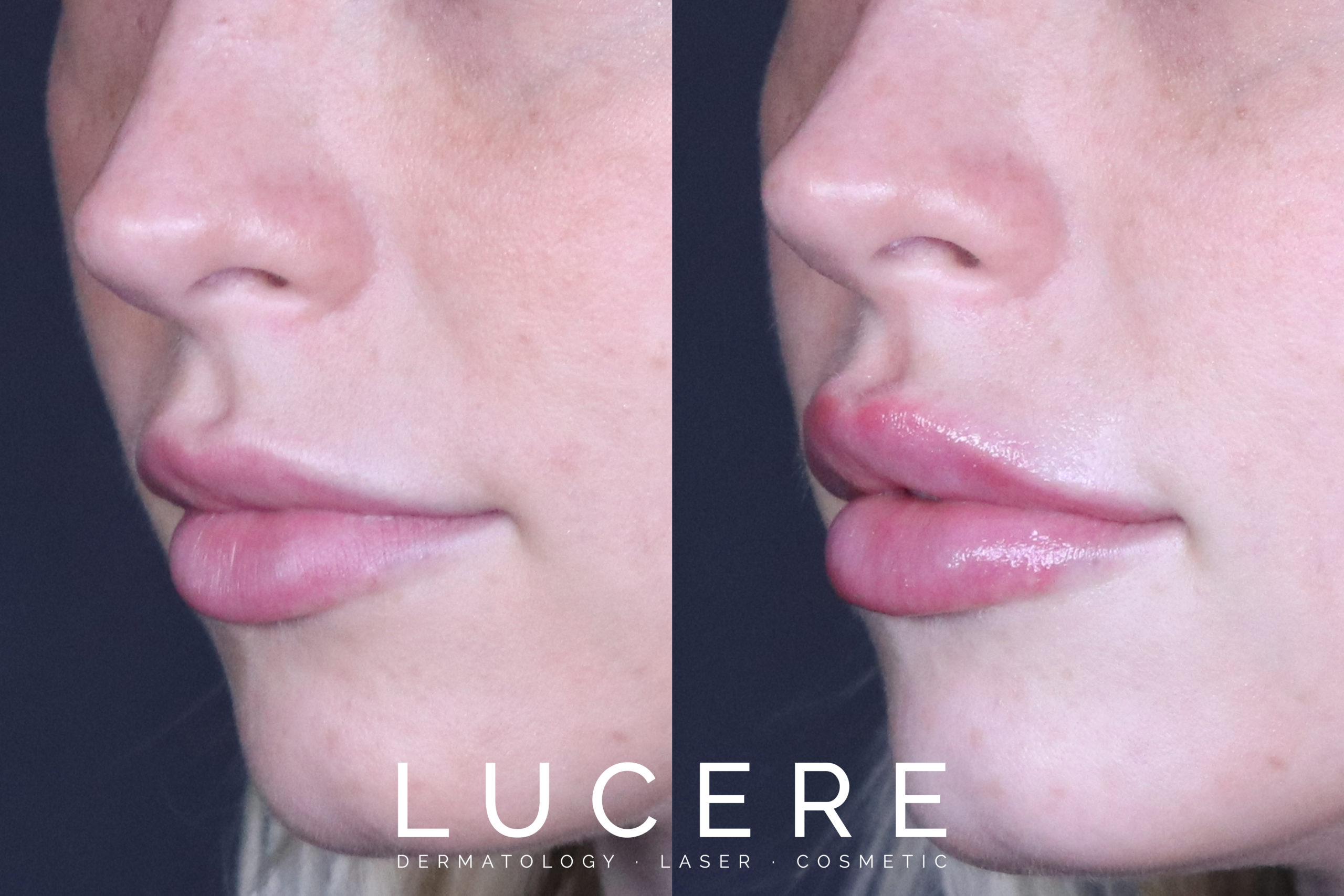 Lip Enhancement: Volume