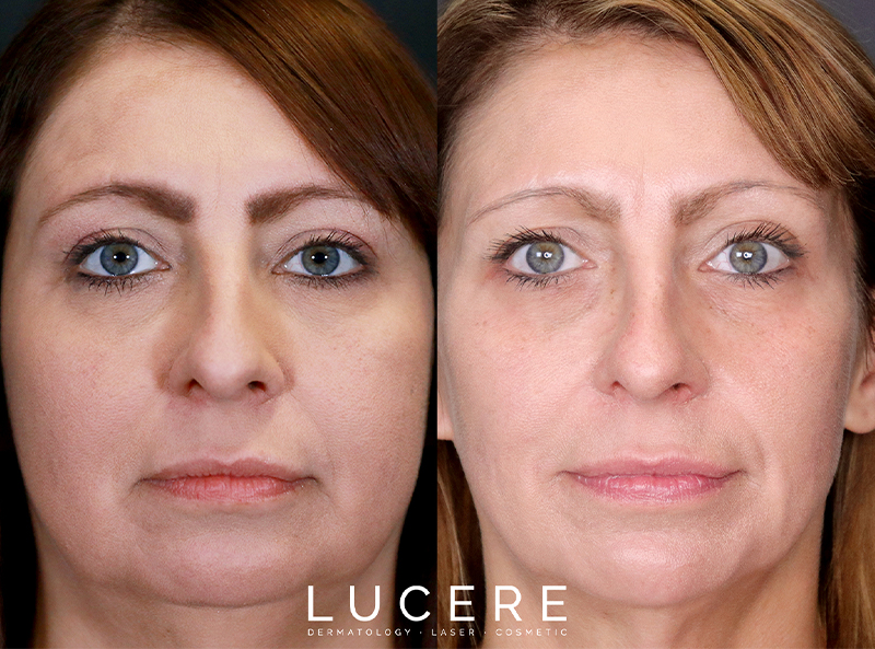 Chin & Profile Enhancement