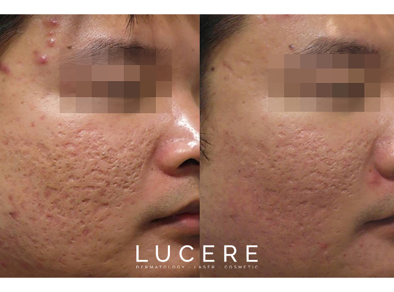 FRACTORA MicroNeedling 2