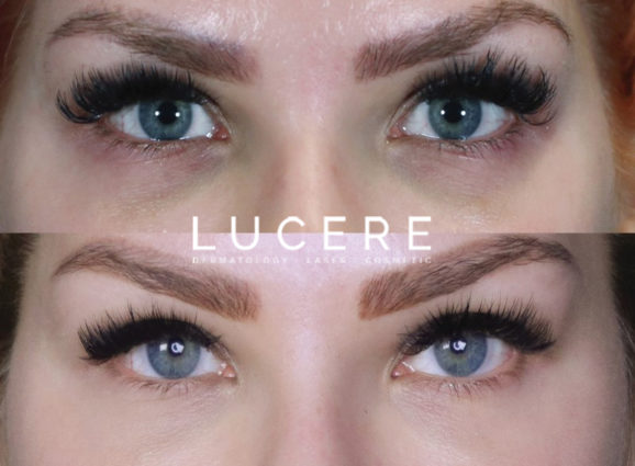 Botox Before & After | Botox & Filler | Botox Results | Lucere ...