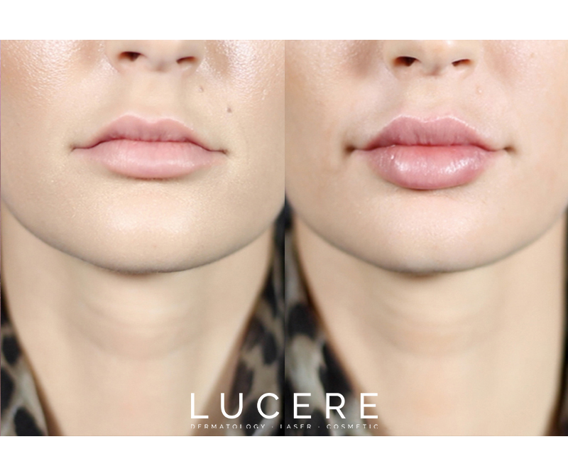 Lip Enhancement: Symmetry, Structure & Volume