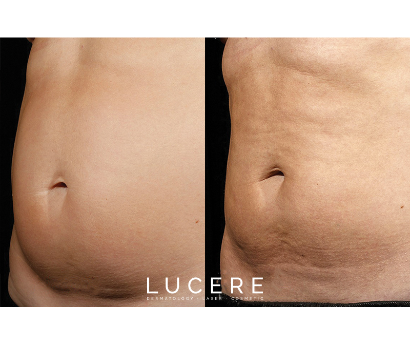 SculpSure (WarmSculpting) Body Contouring