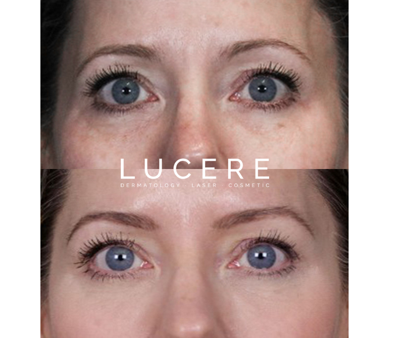 Undereye PRP