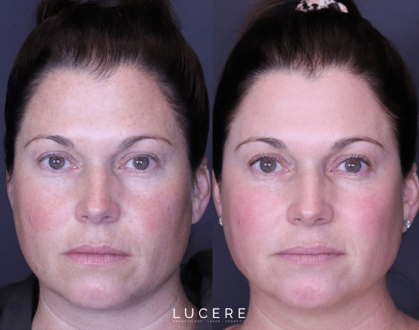 Everything You Need to Know About Skin Resurfacing Treatment | Lucere