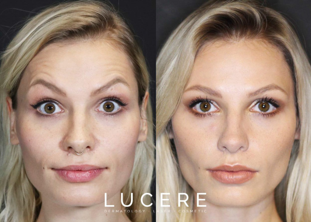 BOTOX 101: Everything You Need to Know About Botox | Lucere