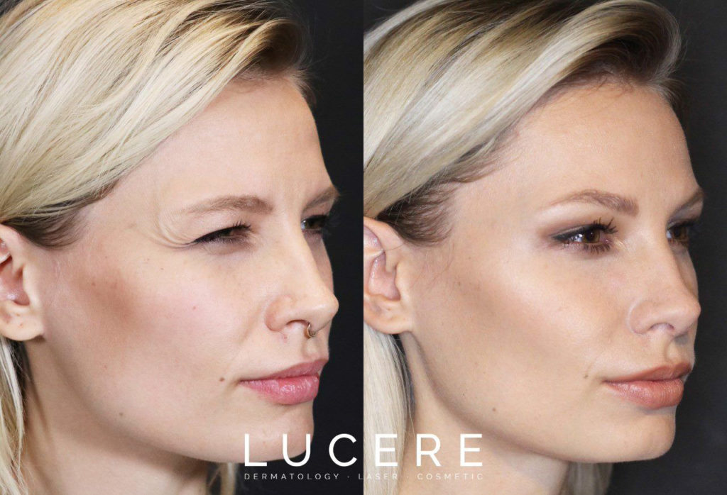 BOTOX 101: Everything You Need to Know About Botox | Lucere