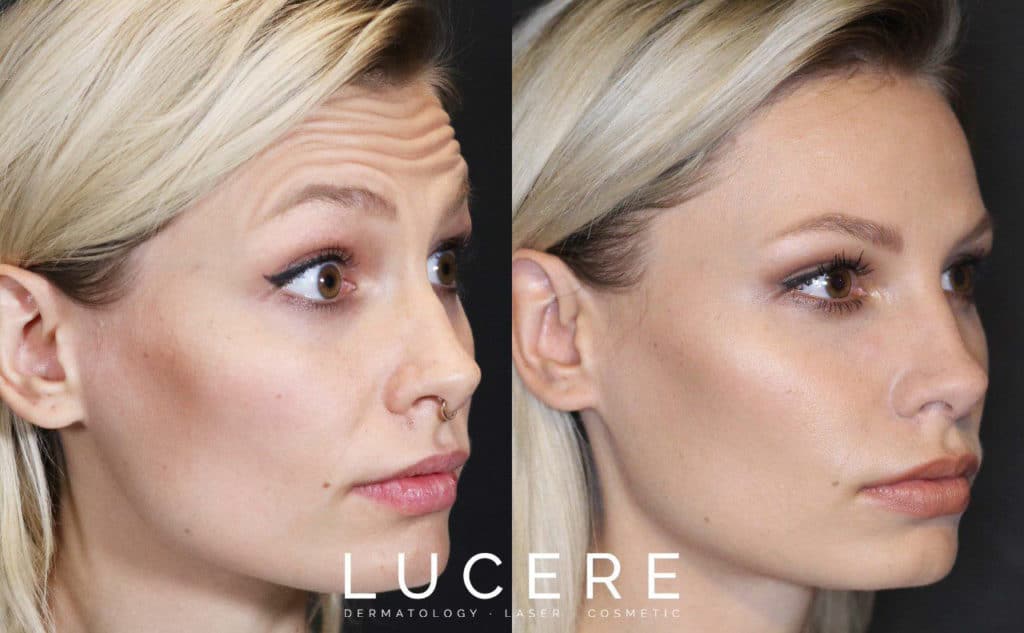 BOTOX 101: Everything You Need to Know About Botox | Lucere