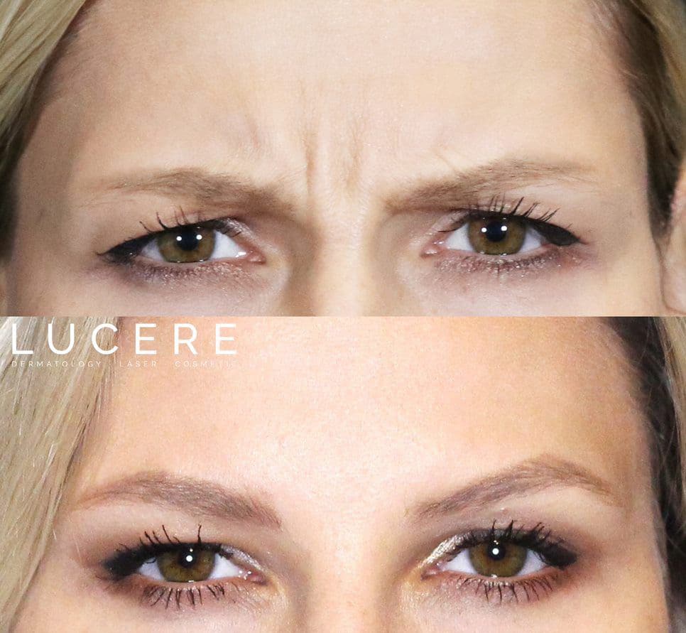 BOTOX 101: Everything You Need to Know About Botox | Lucere