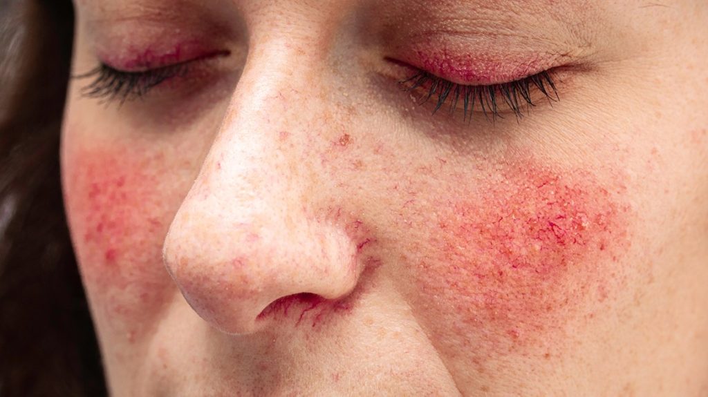 What are the 4 types of Rosacea and How to Treat Them - Lucere