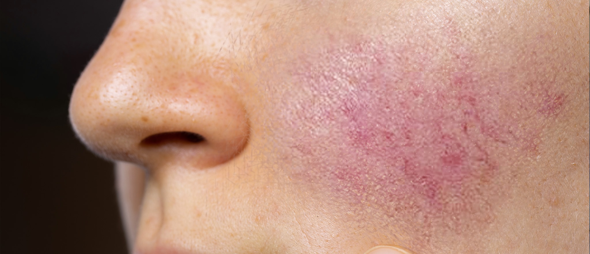 What are the 4 types of Rosacea and How to Treat Them - Lucere