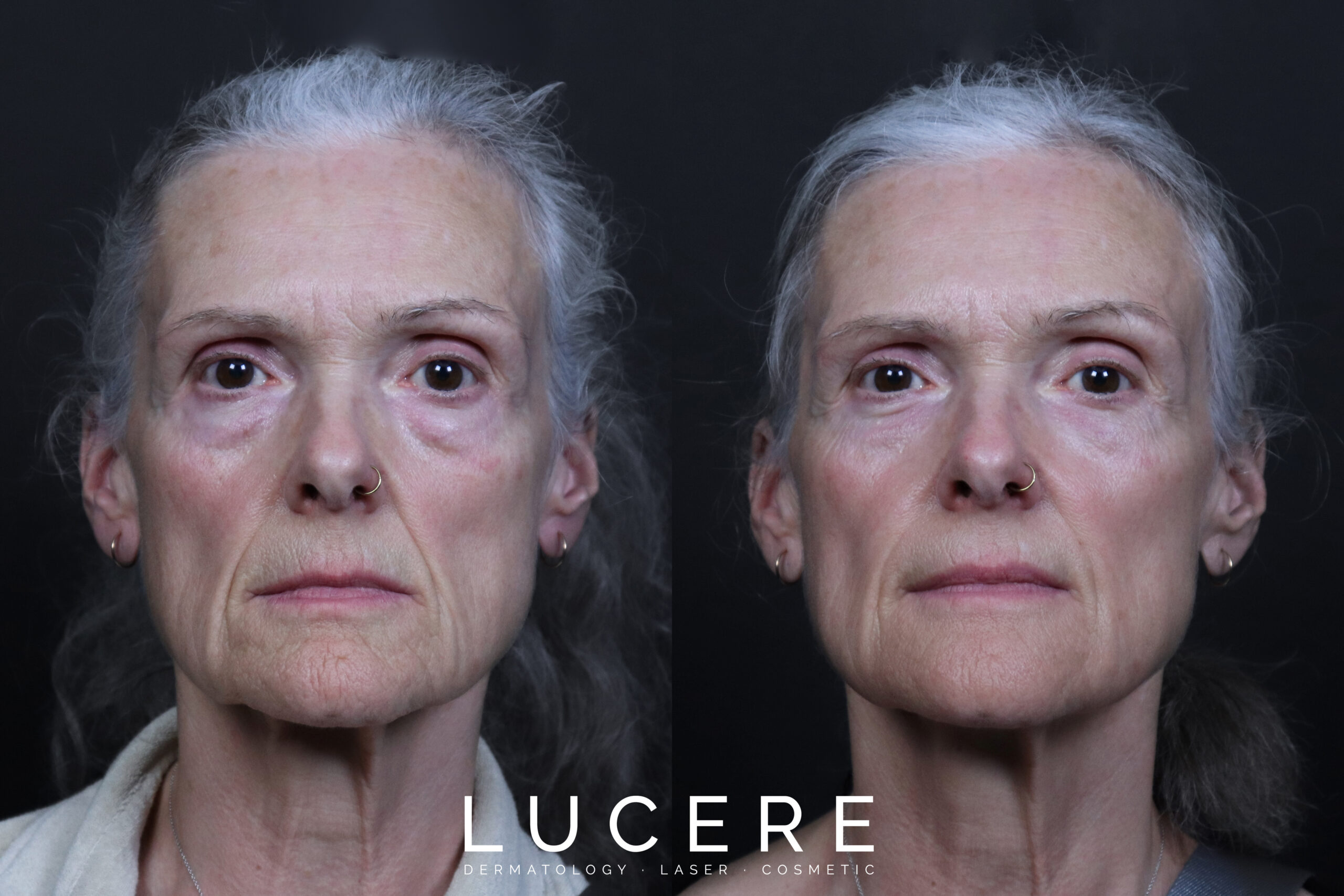 Full Face Filler